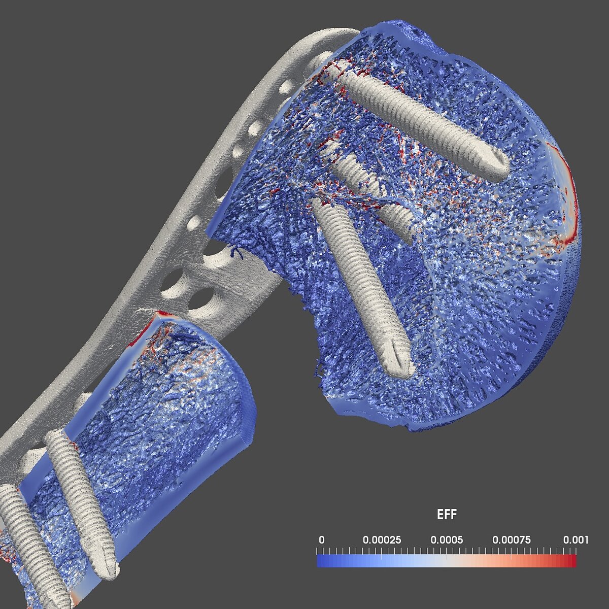 Computer Simulations of Fracture Fixations in Osteoporotic Bones | CSCS